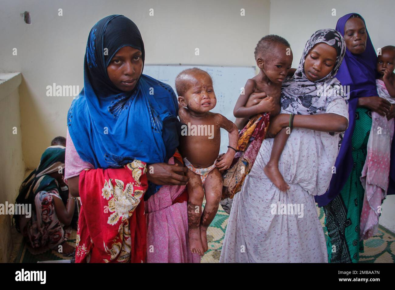 Somali children displaced by drought and showing symptoms of ...