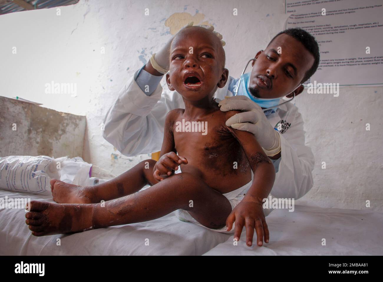 Doctor Mustaf Yusuf treats Ali Osman, 3, who is showing symptoms of ...