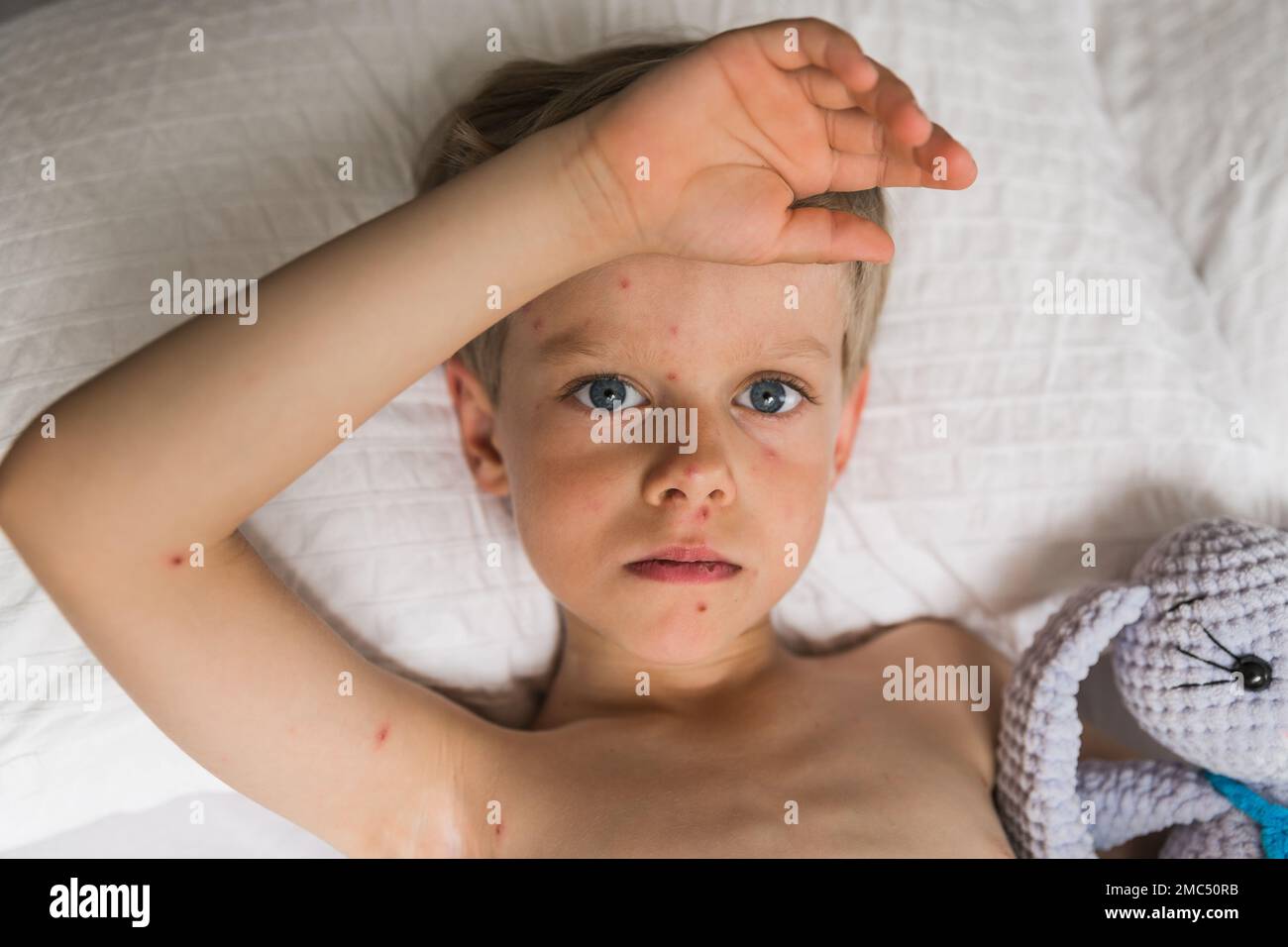 Jeune enfant avec la varicelle. Enfant malade avec la varicelle. Virus ...