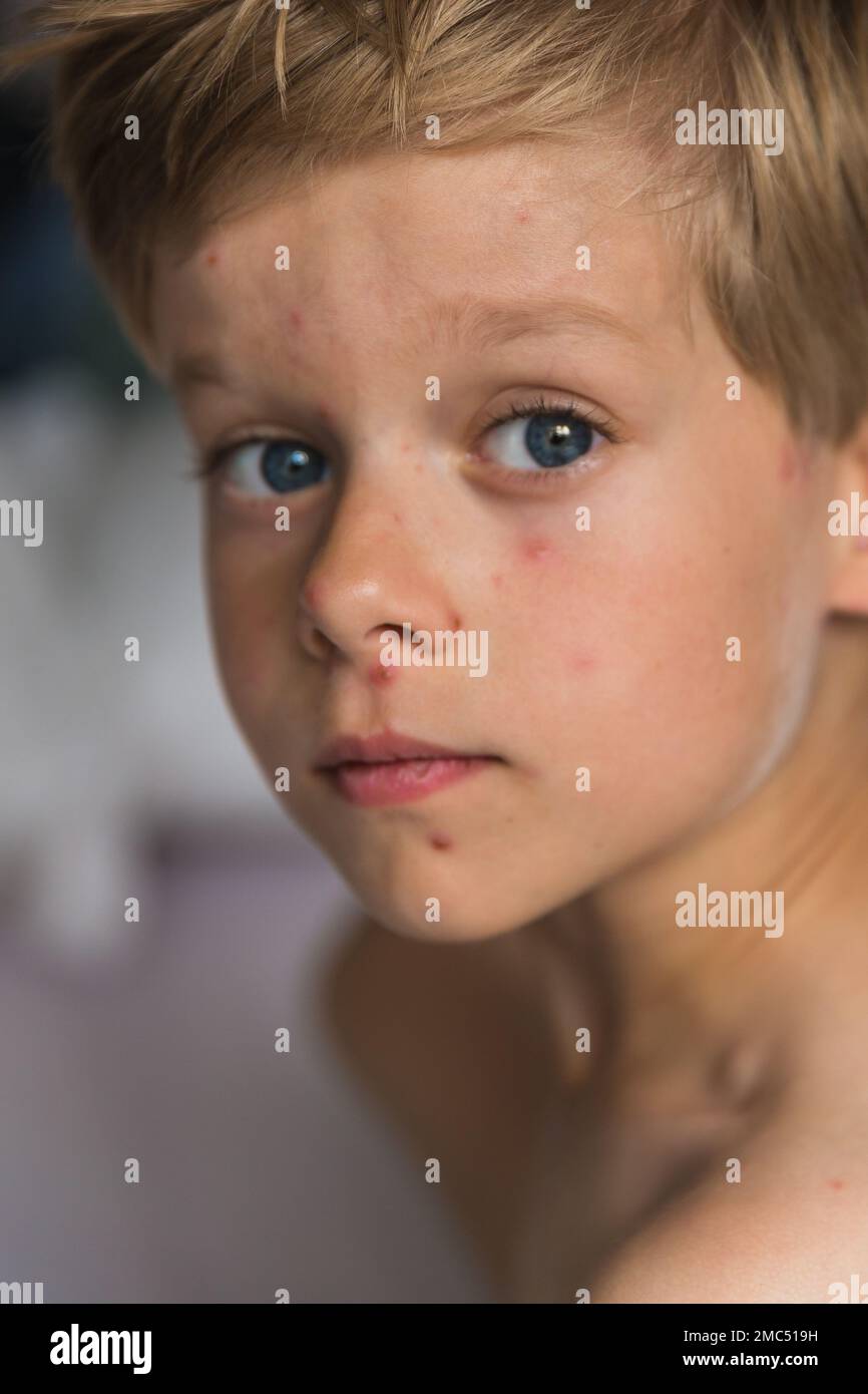 Jeune enfant avec la varicelle. Enfant malade avec la varicelle. Virus ...