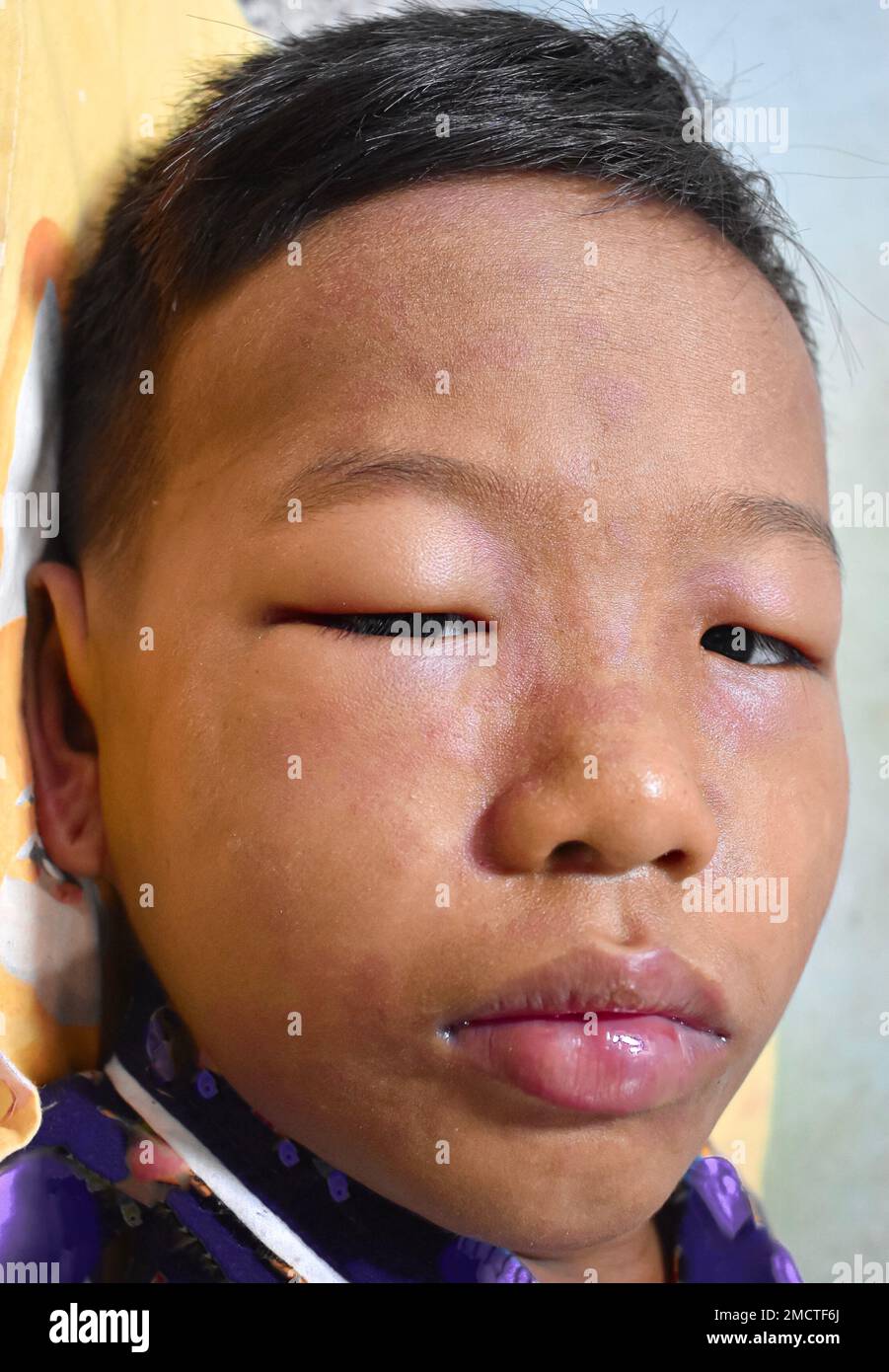 Œdème de Quincke sur les paupières et les lèvres de l'enfant mâle d'Asie du Sud-est. Enfant ...