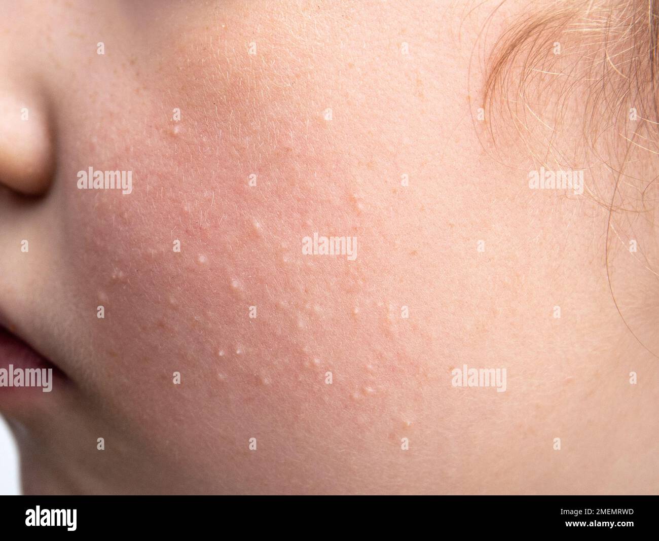 Les petites Milia (taches de lait) sont des kystes blancs sur la peau ...