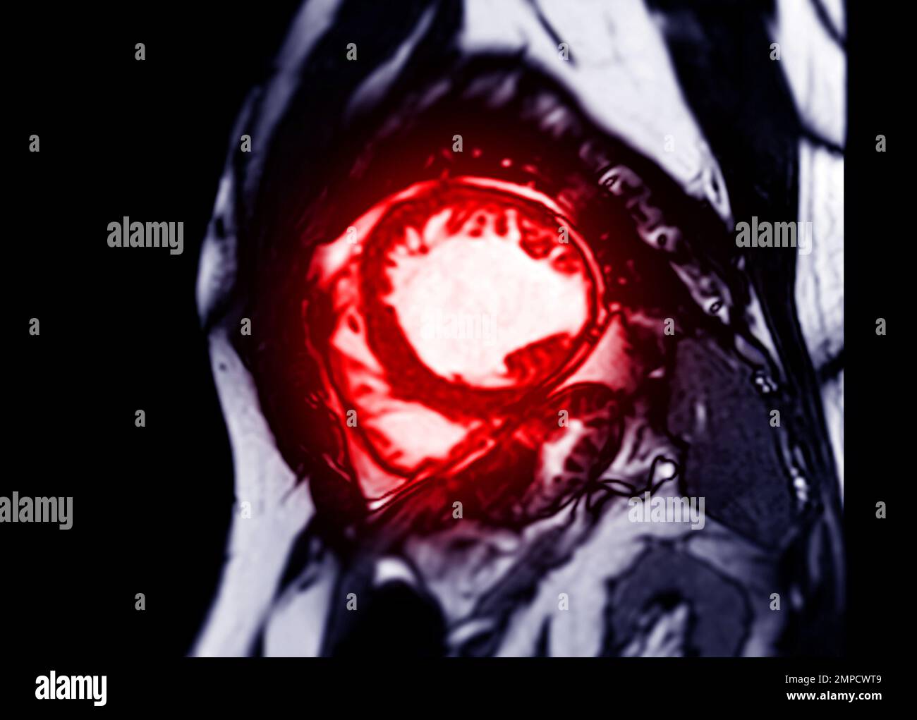 IRM cardiaque ou cardiaque IRM cardiaque en vue petit axe montrant les coupes transversales du ...