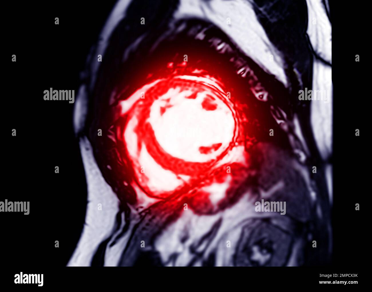 IRM cardiaque ou cardiaque IRM cardiaque en vue petit axe montrant les coupes transversales du ...