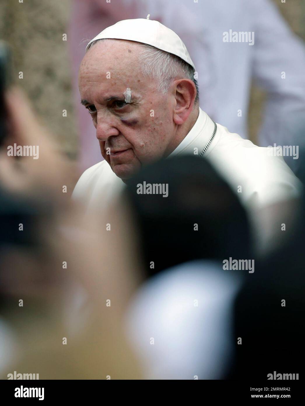 After he suffered a bruise to his left cheek that resulted in some ...