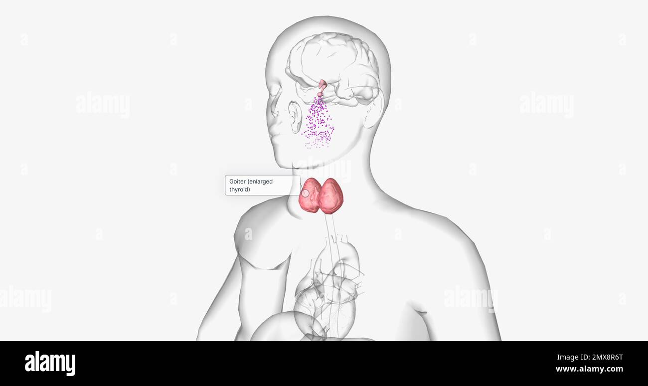Hashimoto thyroiditis Banque de photographies et d’images à haute ...