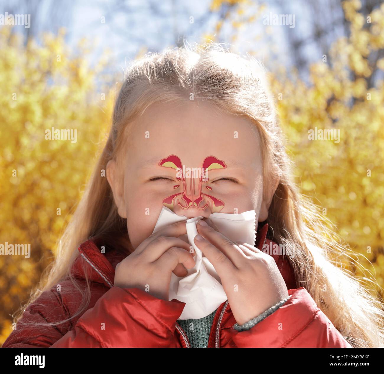 Petite fille souffrant de nez qui coule comme symptôme d'allergie à l'extérieur. Illustration ...