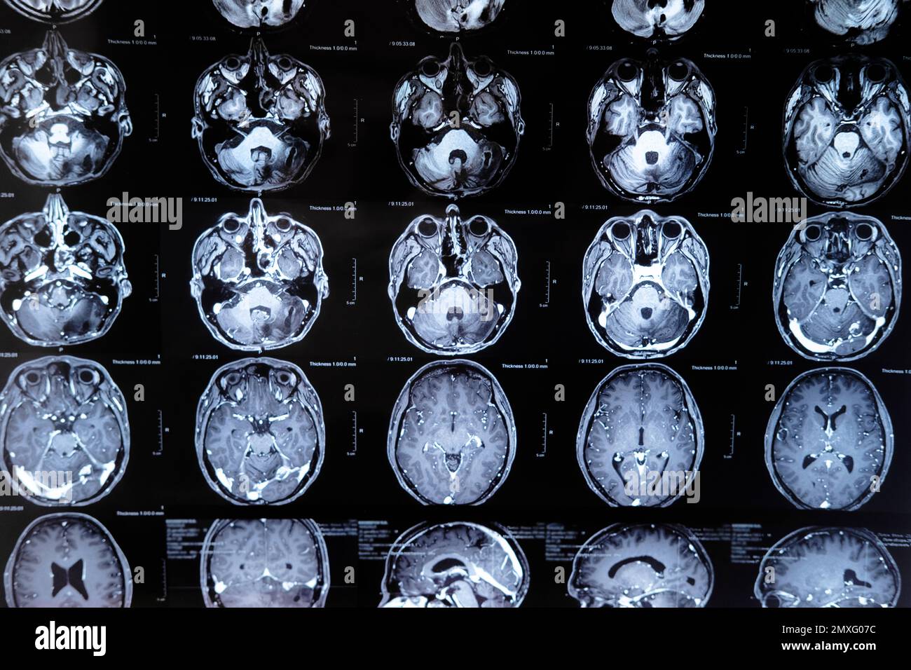 irm avec tumeur cérébrale. Imagerie par résonance magnétique Photo Stock - Alamy