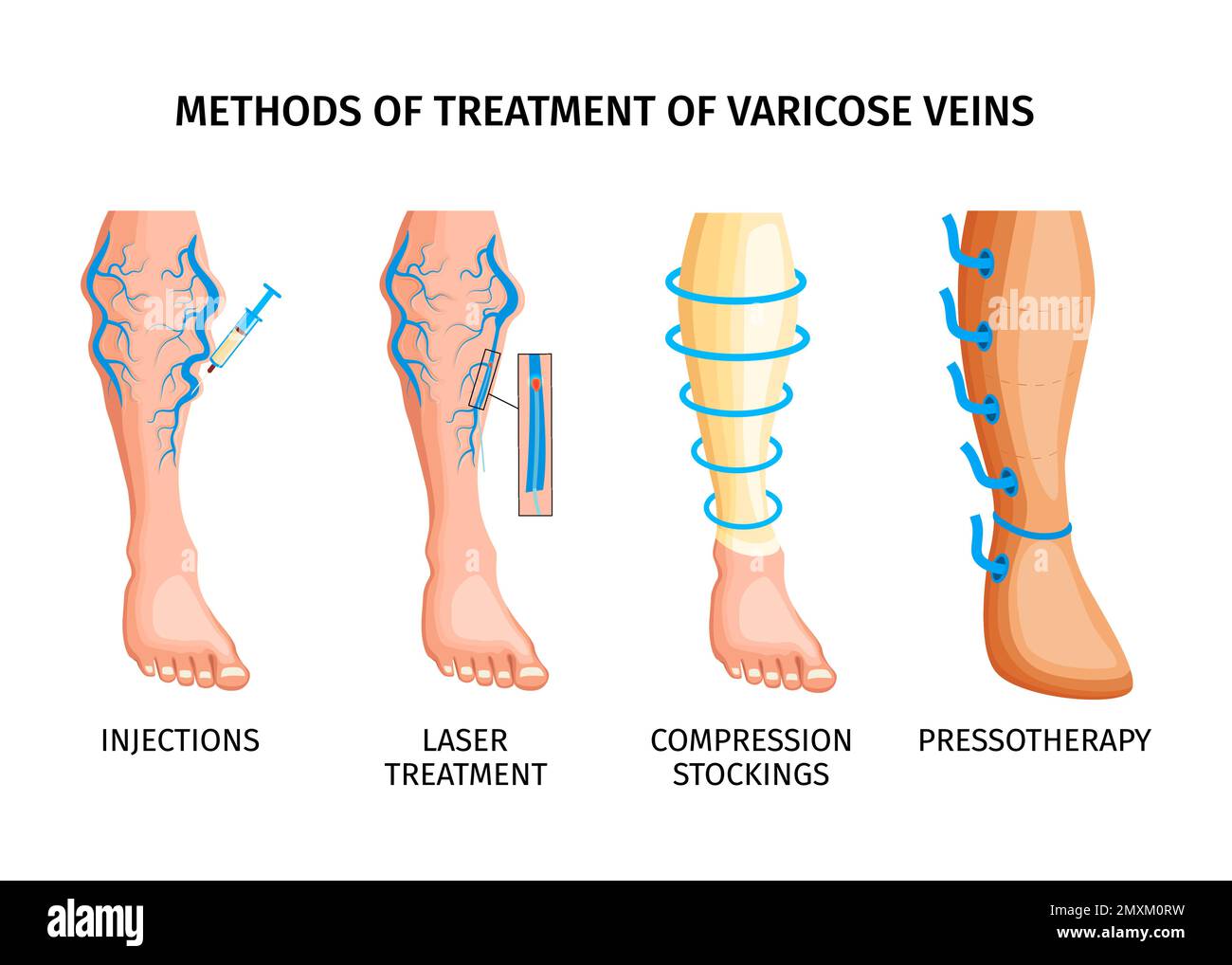 Méthodes de traitement des varices affiche réaliste représentant des ...