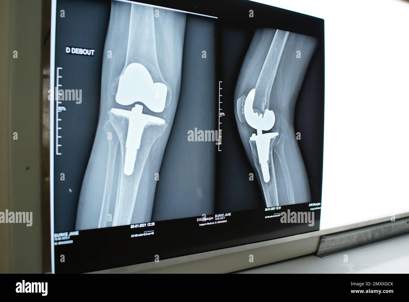 Radiographie d'une arthroplastie totale du genou Banque de ...