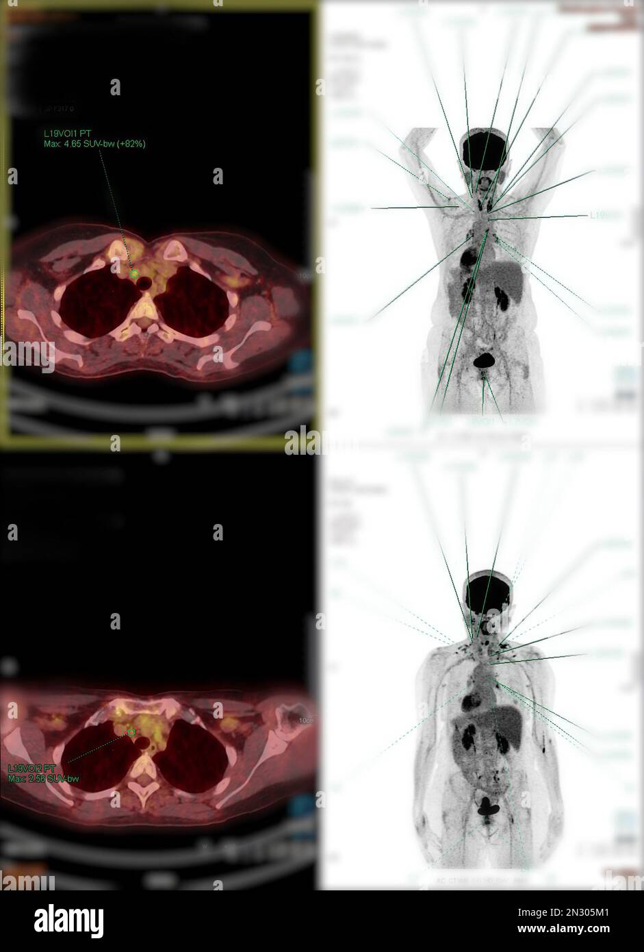 La tomographie par émission de positrons (TEP) CT scan utilise un ...
