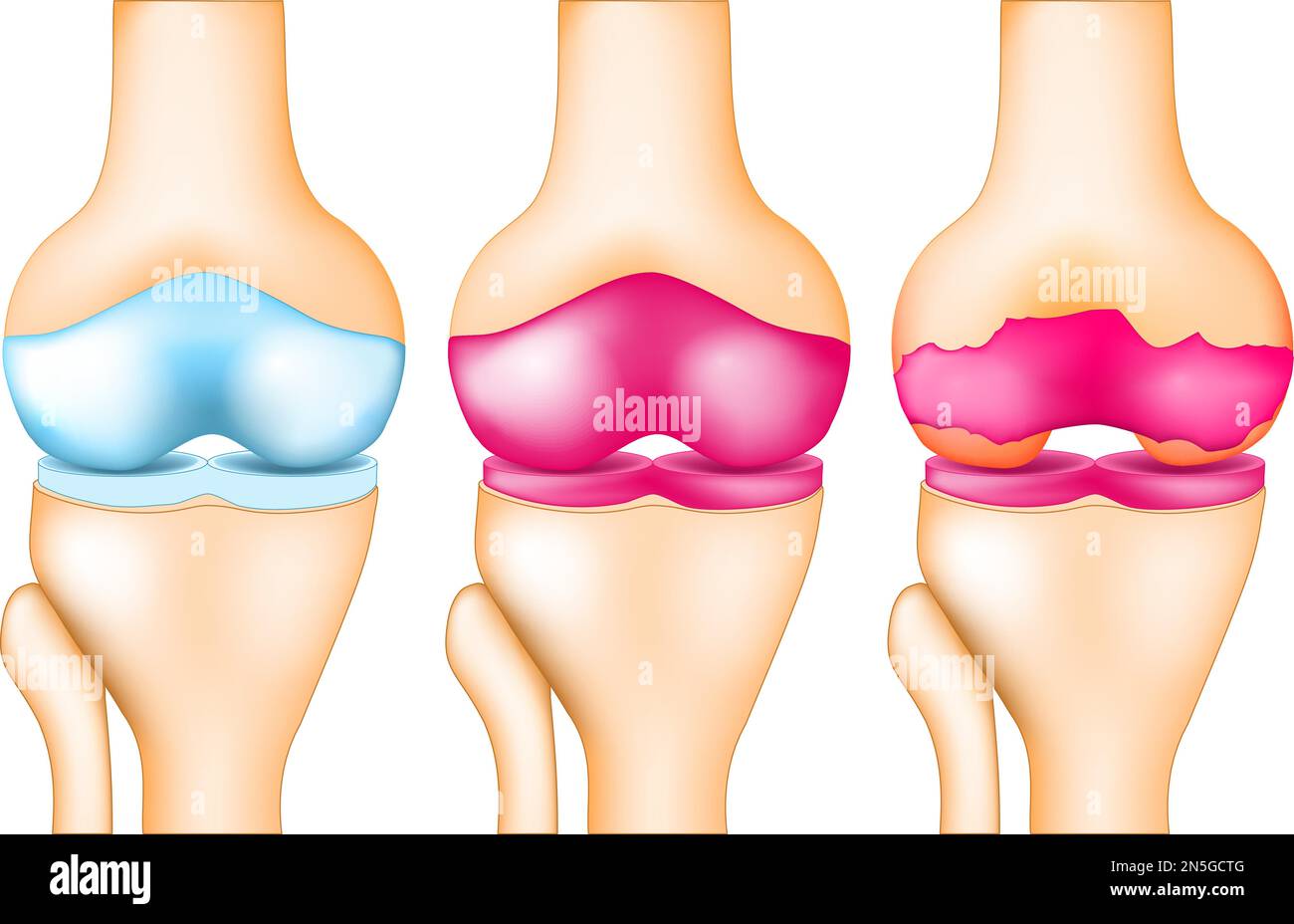 Genou humain en bonne santé, inflammation articulaire, arthrose ou ... Genou humain en bonne santé, inflammation articulaire, arthrose ou ...