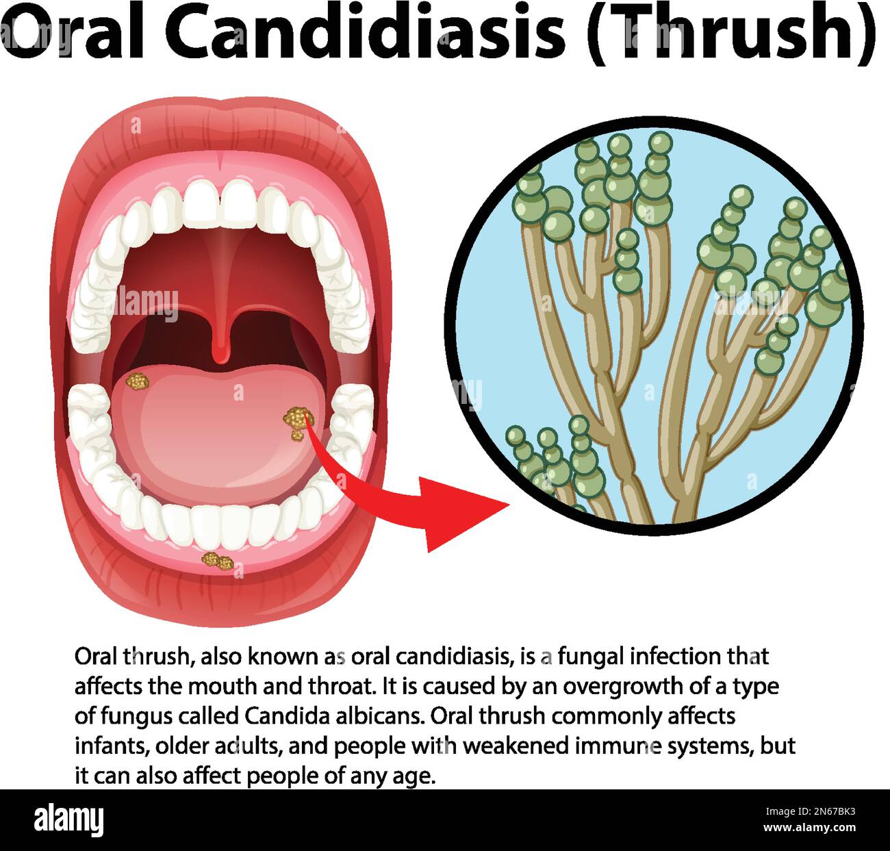 Candidose buccale Banque de photographies et d’images à haute ...