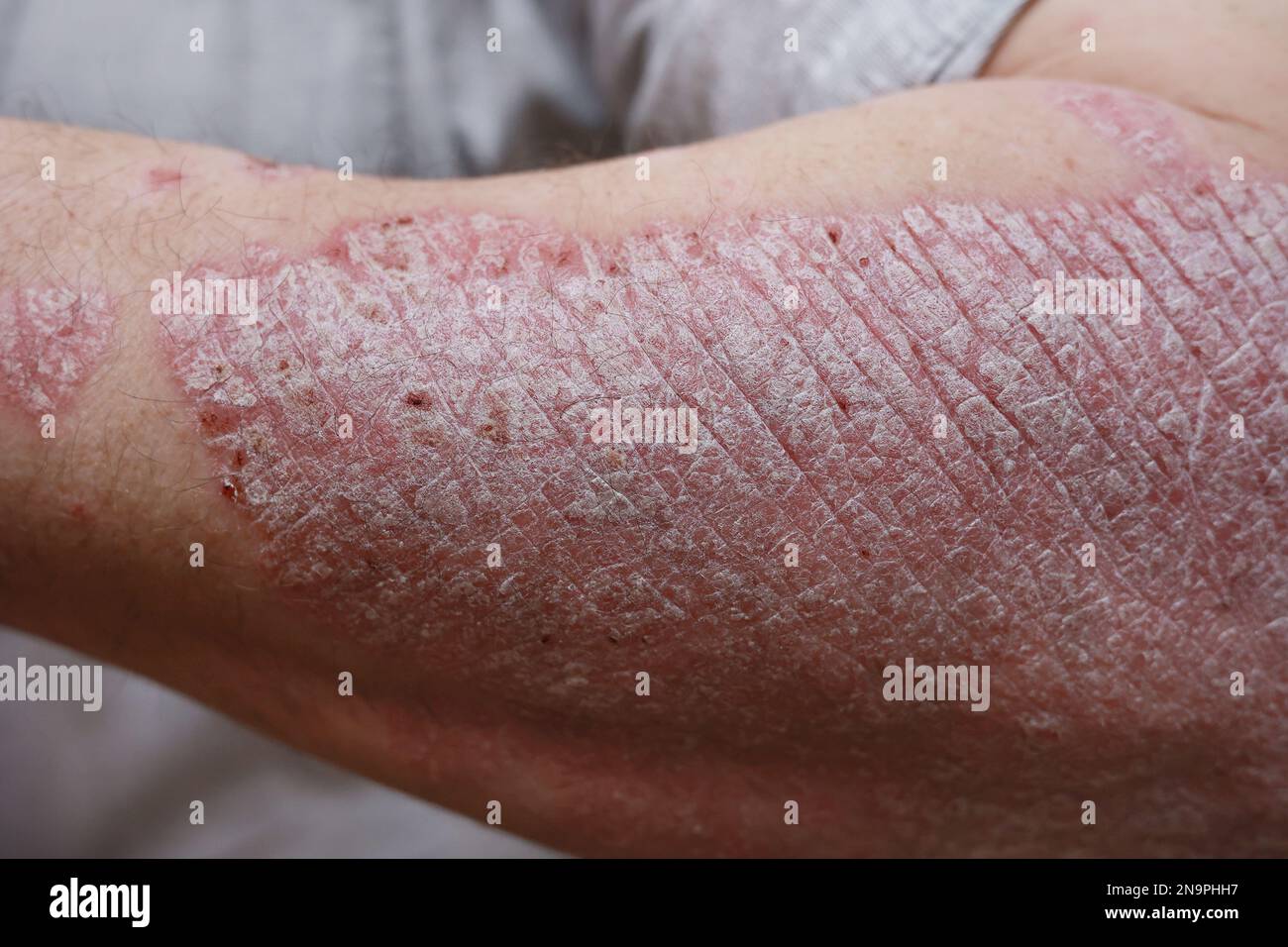 Gros plan, macro de psoriasis peau, maladie auto-immune qui affecte la ...