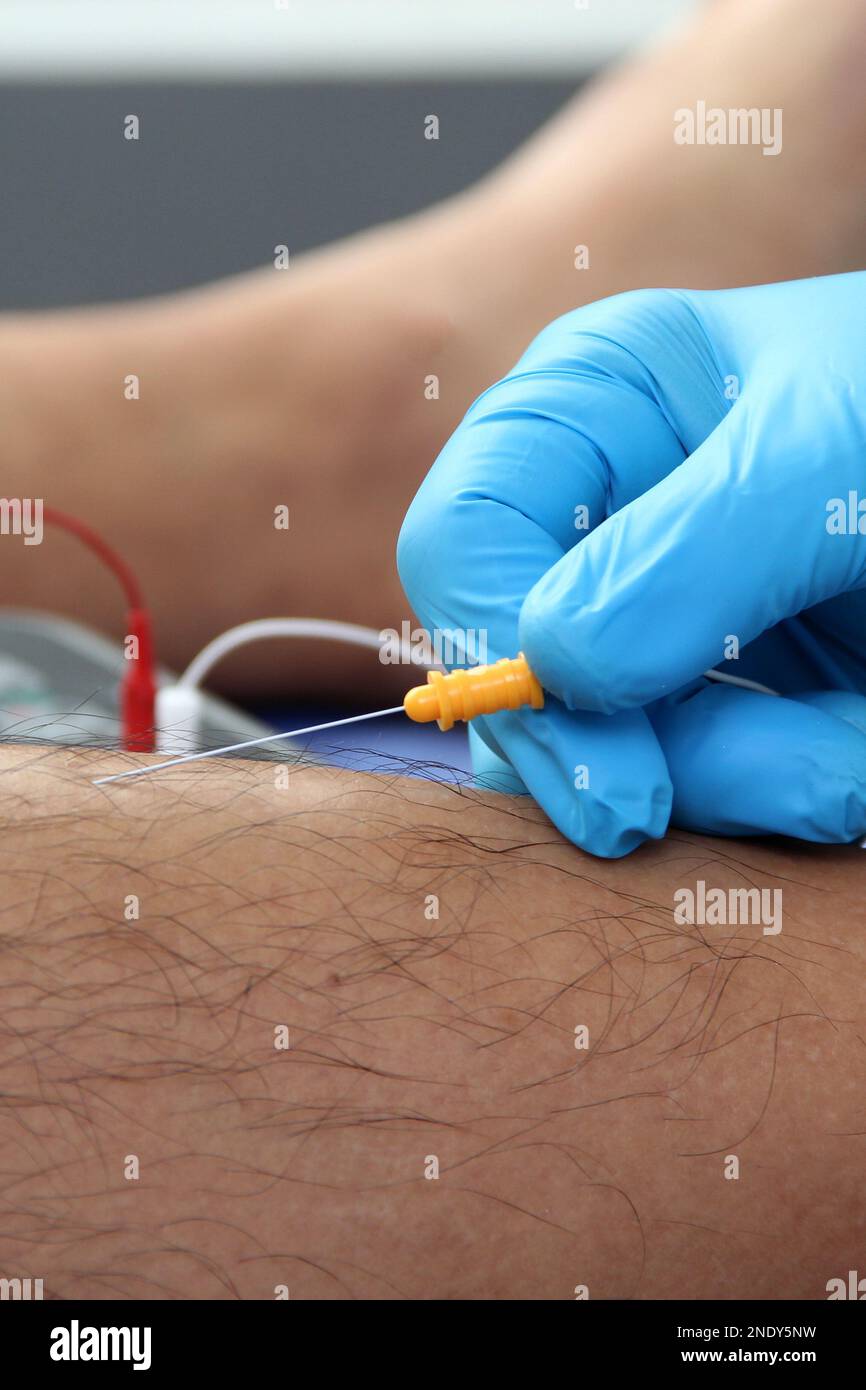 Électromyographie dans les membres inférieurs, technique d ...