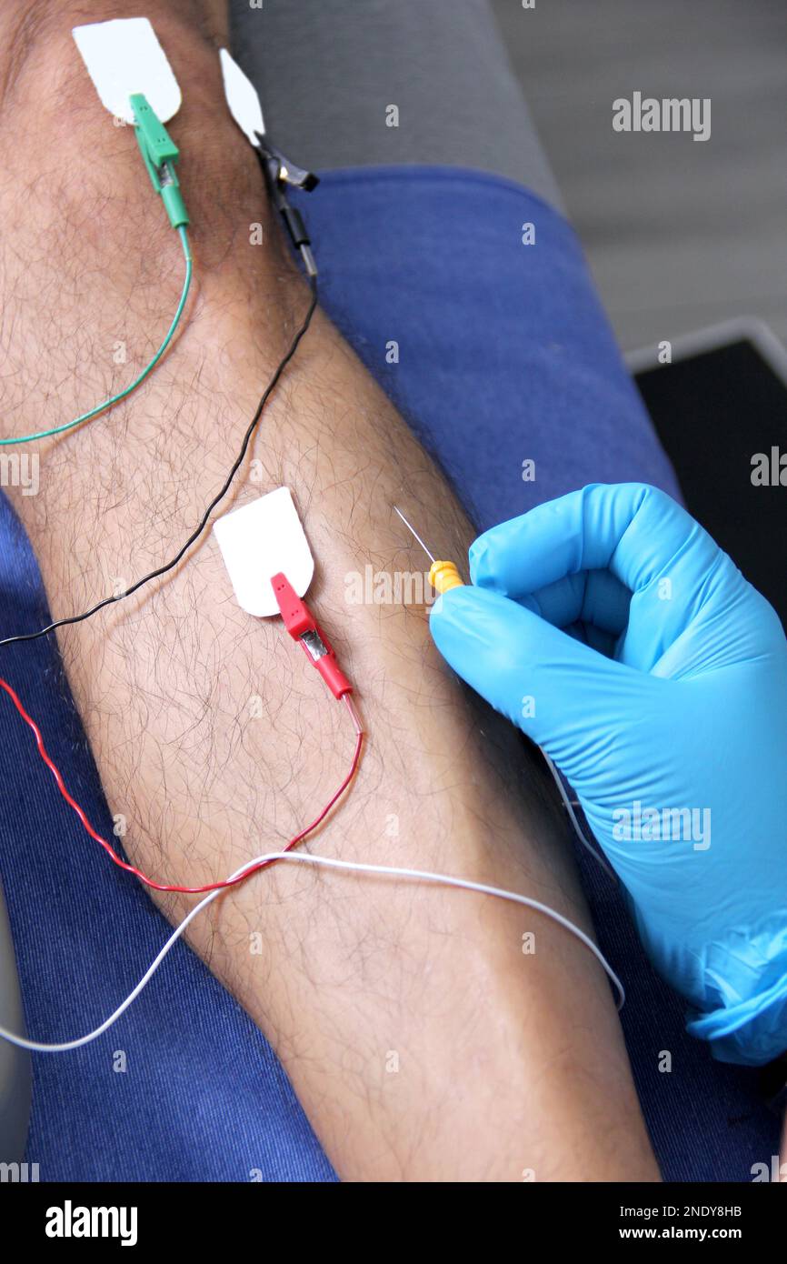 Électromyographie dans les membres inférieurs, technique d ...