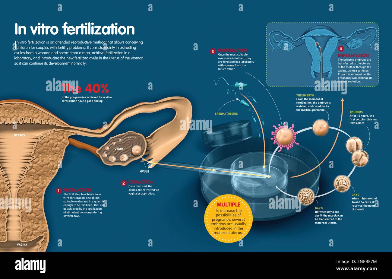 Infographie sur le processus de fécondation in vitro, technique de ...