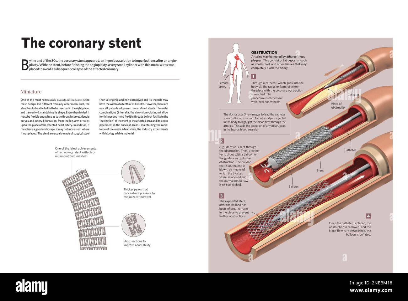 Infographie sur les stents cardiaques, une technique chirurgicale pour ...