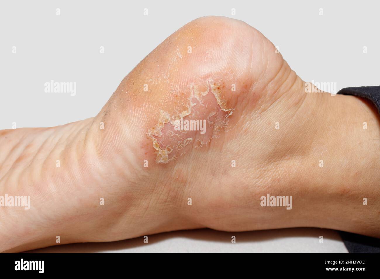 Eczéma Dyshidrotique Banque De Photographies Et Dimages à Haute Résolution Alamy