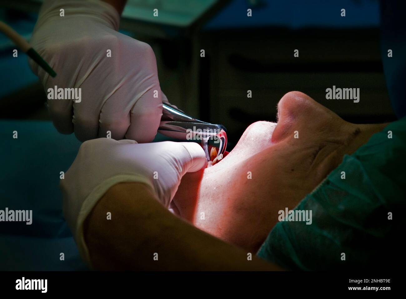 Tooth extraction Banque de photographies et d’images à haute résolution - Alamy