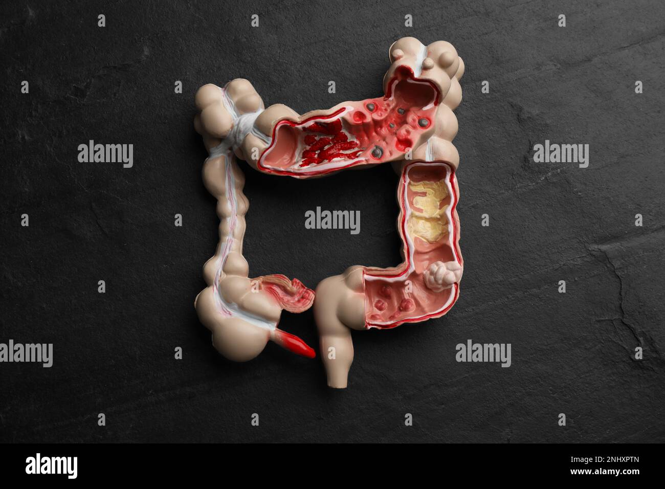 Colon humain Banque de photographies et d’images à haute résolution - Alamy