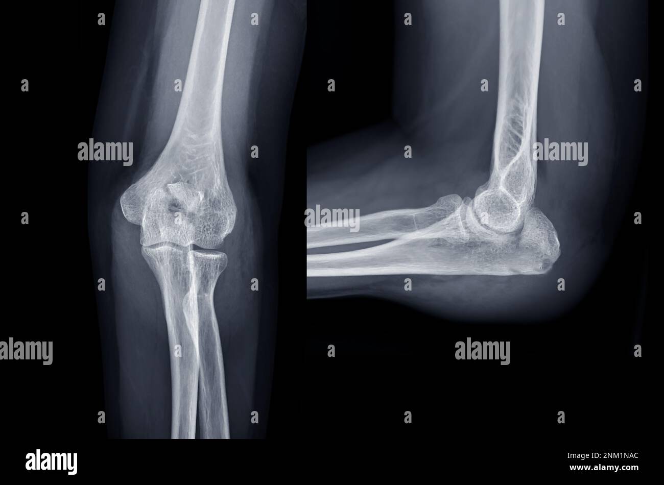 Rayons X de l'articulation du coude montrant une fracture de l'os du ...
