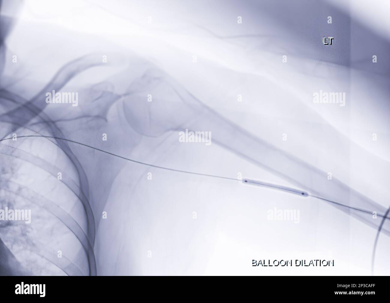 Angioplastie, angioplastie par ballonnet et angioplastie transluminale ...