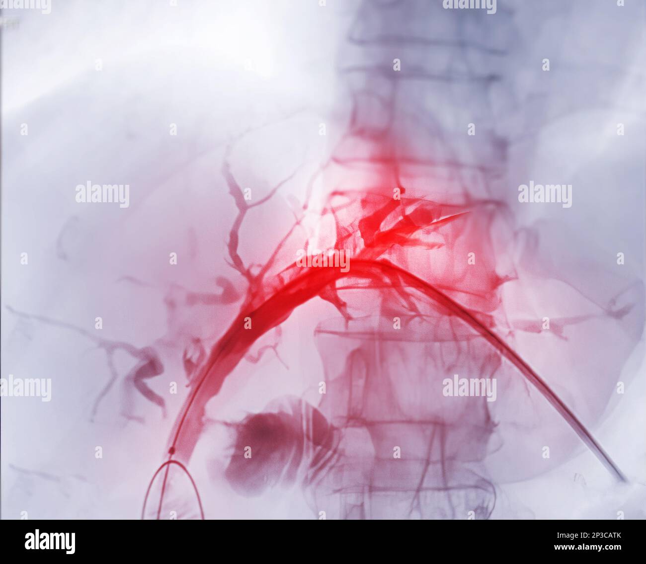 Image radiographique de la veine porte après le Doctor Doctor Doing ...