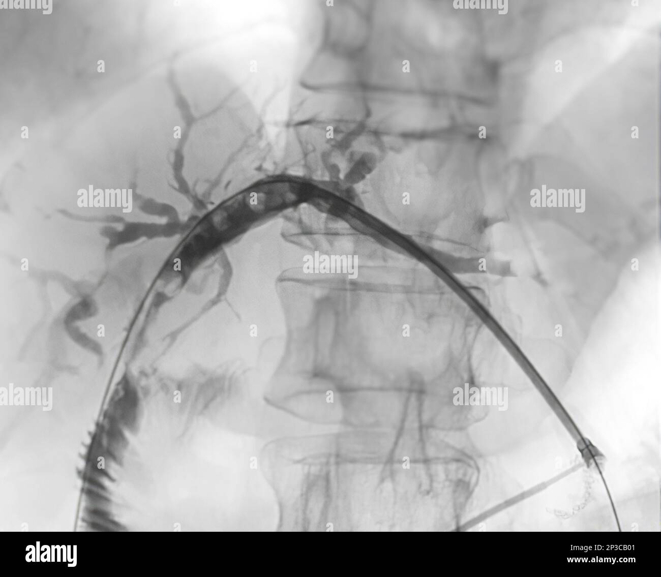 Image radiographique de la veine porte après le Doctor Doctor Doing ...