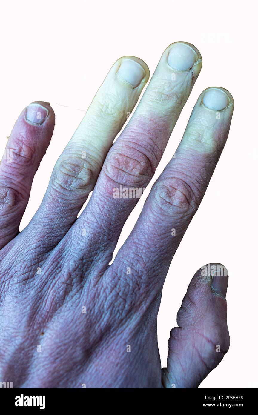Une main masculine frostbitten avec le syndrome de Raynaud, le ...