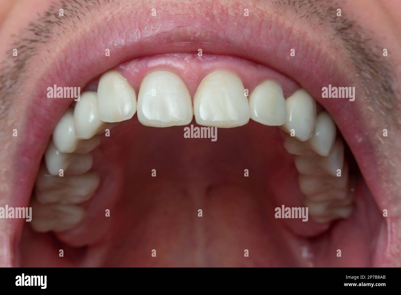 Prise de vue macro à ouverture de la bouche mâle caucasienne. Rangée de ...