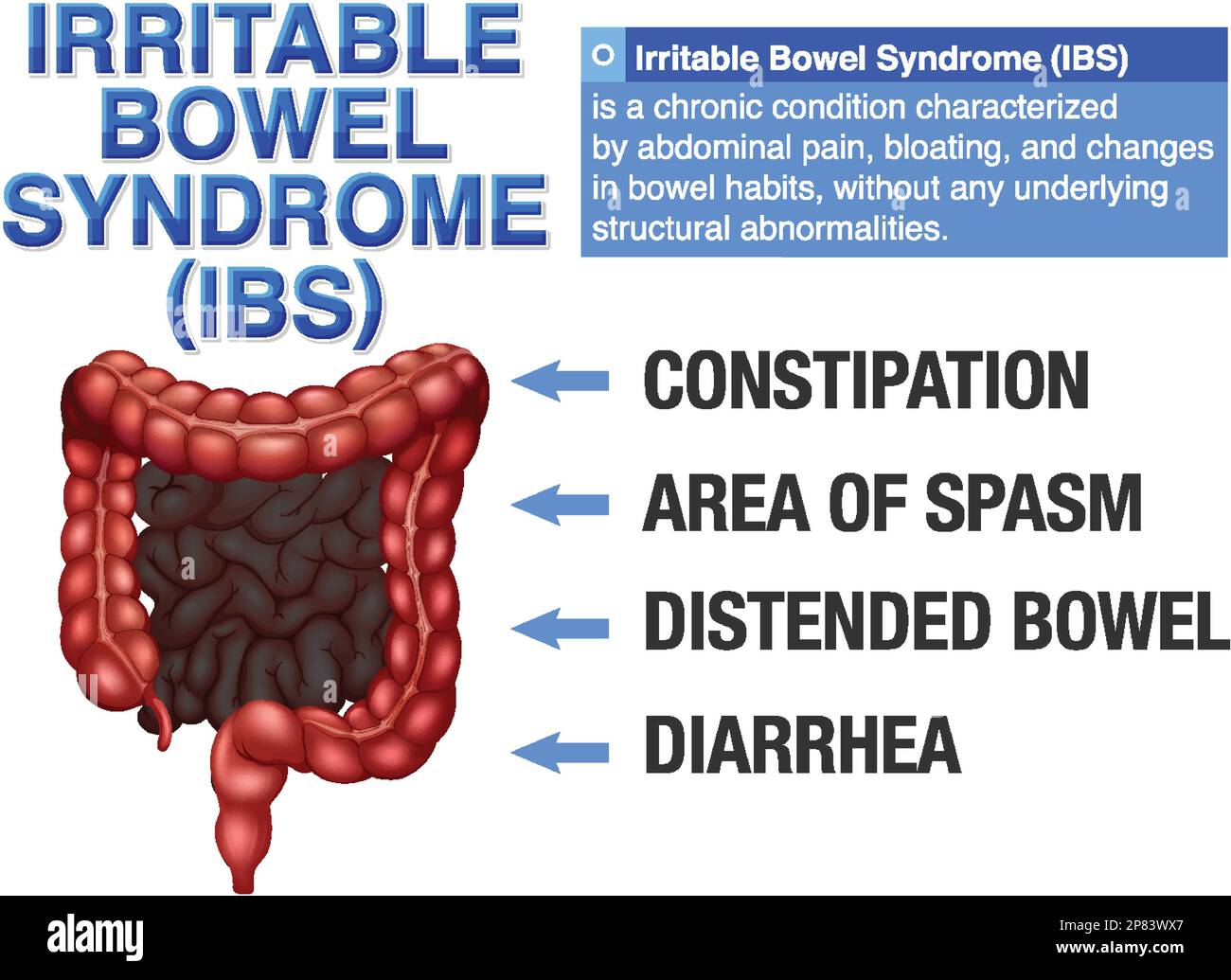 Syndrome de l'intestin irritable Banque d'images vectorielles - Alamy