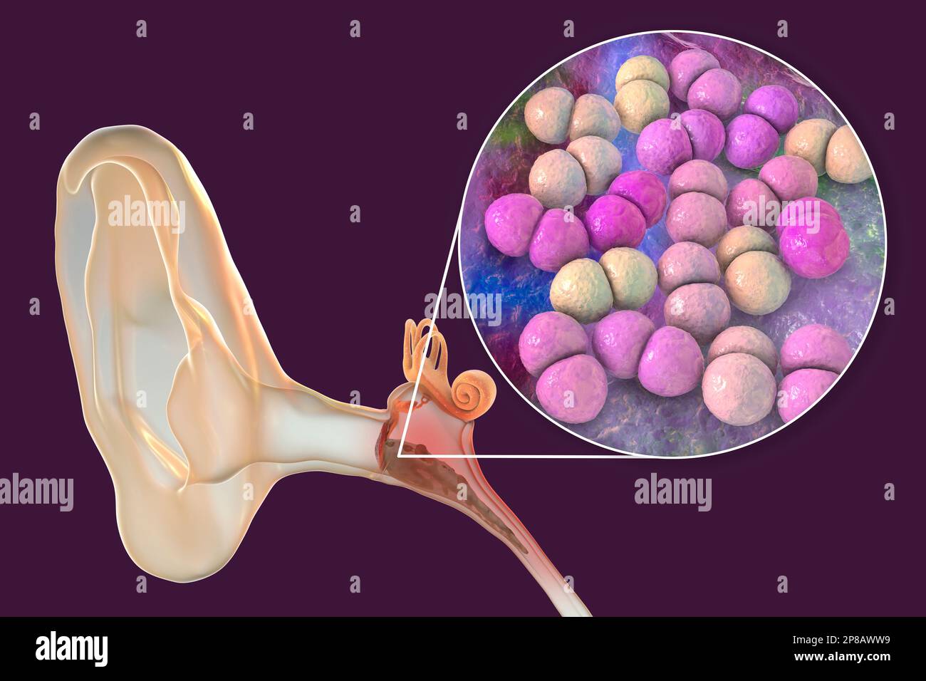 Otite moyenne infection de l'oreille causée par la bactérie ...