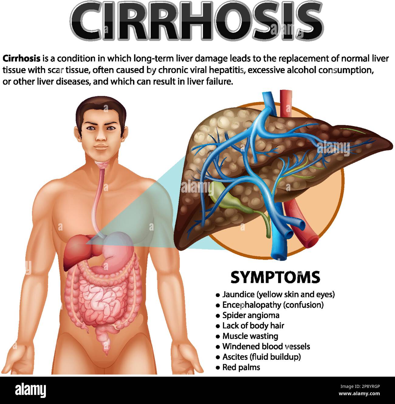 Maladie alcoolique du foie Banque d'images vectorielles - Page 2 - Alamy