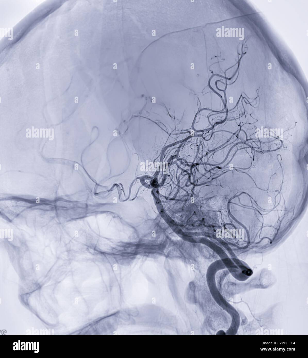Angiographie cérébrale image ou artère cérébrale potertérior de la ...