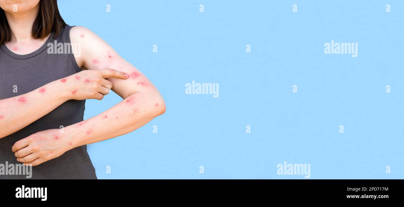 La nouvelle maladie de Monkeypox est dangereuse dans le monde entier ...