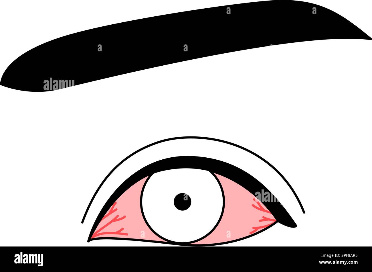 Medical Clipart, Line Drawing Illustration of Eye Disease and ...