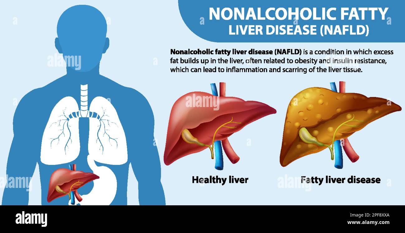 Illustration de la stéatose hépatique non alcoolique (NAFLD Image ...