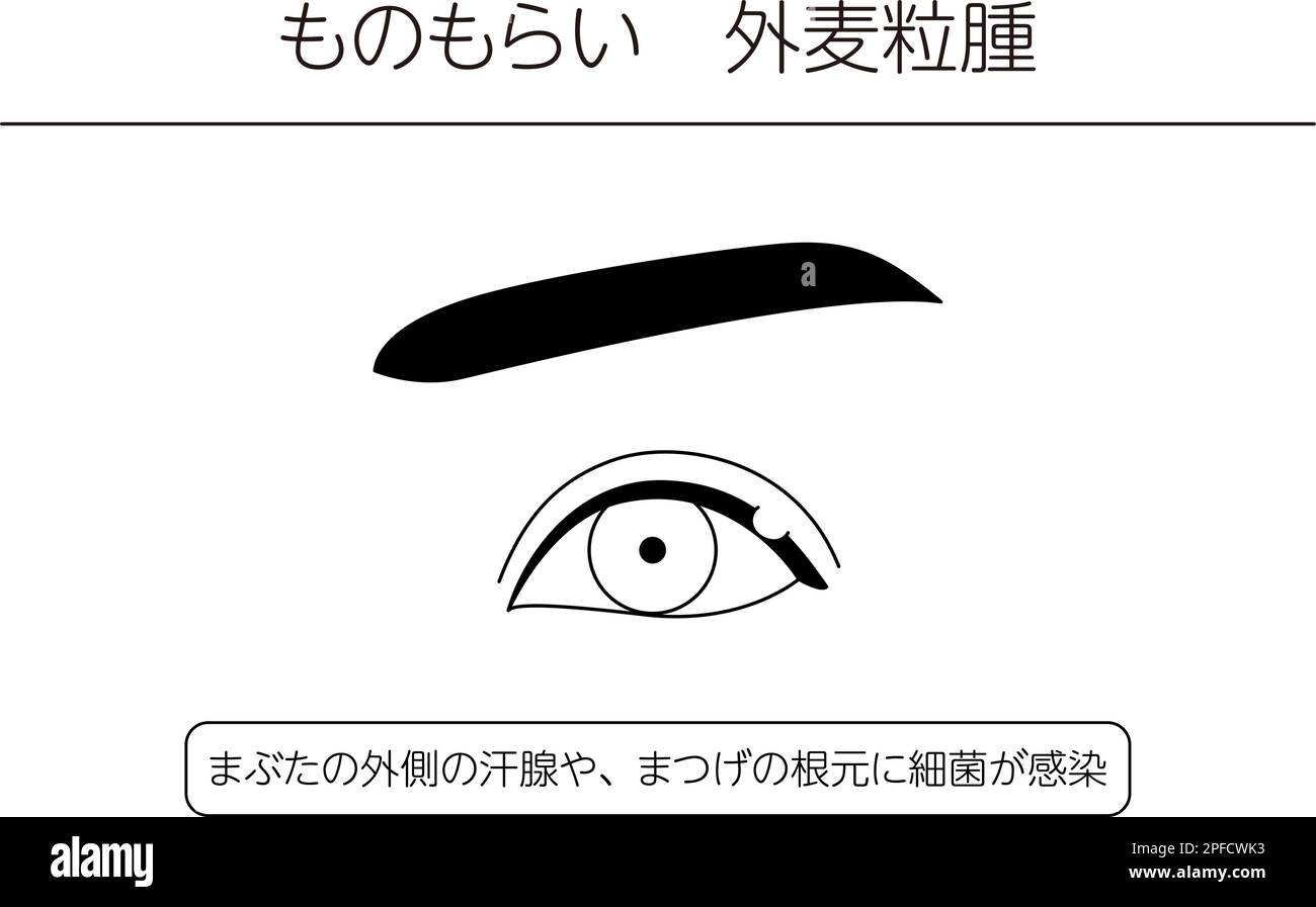 Eyelid swelling Banque d'images vectorielles - Alamy