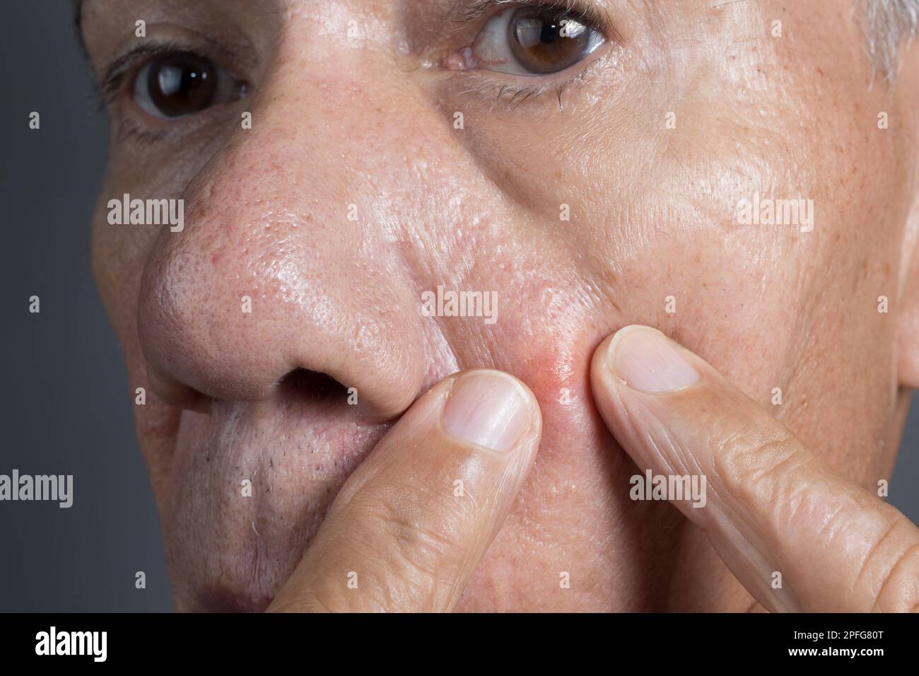Gros bouton sur la peau Banque de photographies et d’images à haute ...