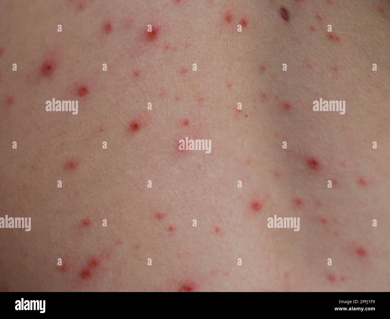 Varicelle enfant Banque de photographies et d’images à haute résolution ...