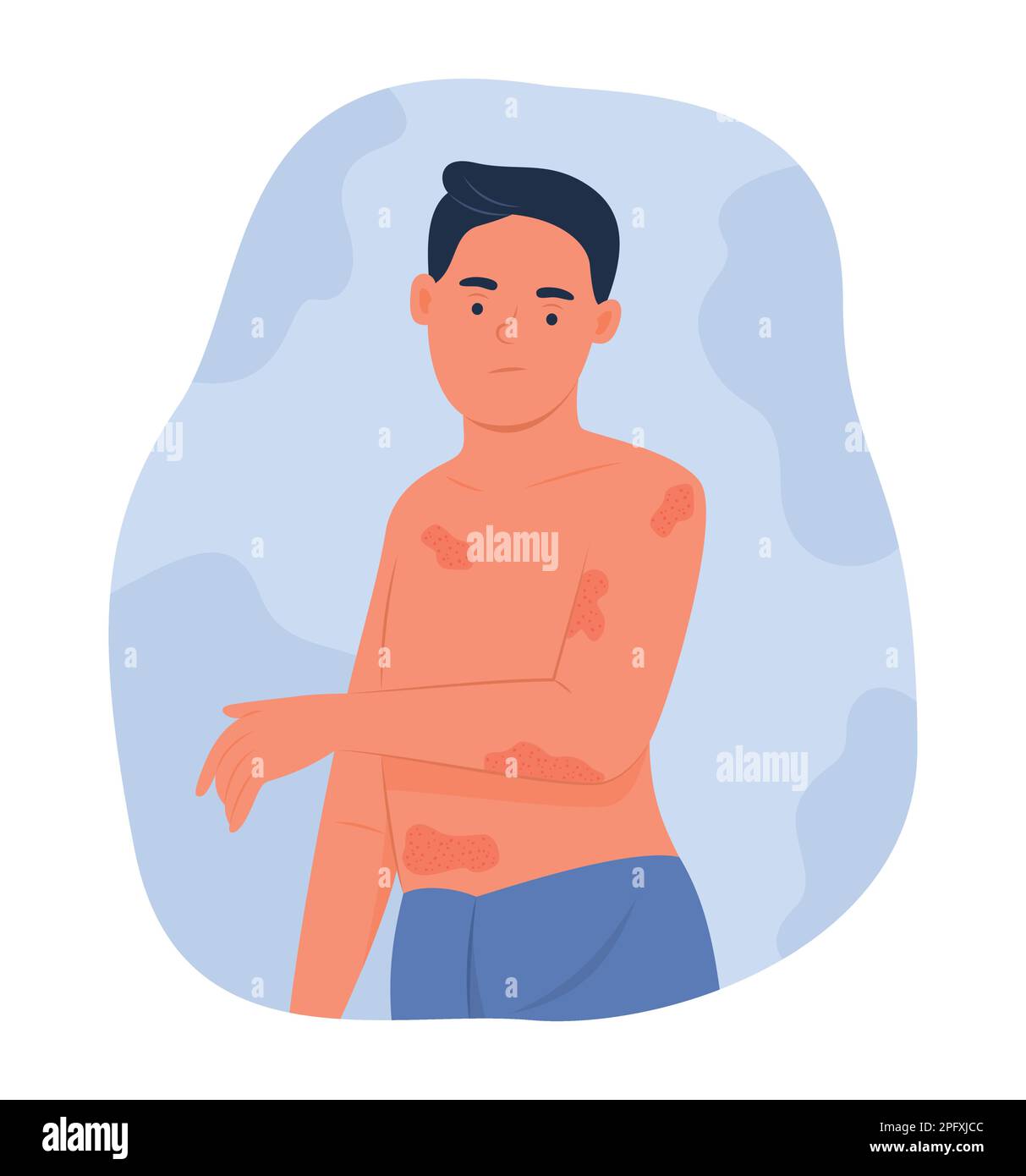 Homme avec une dermatite atopique ou un eczéma sur le corps Image ...