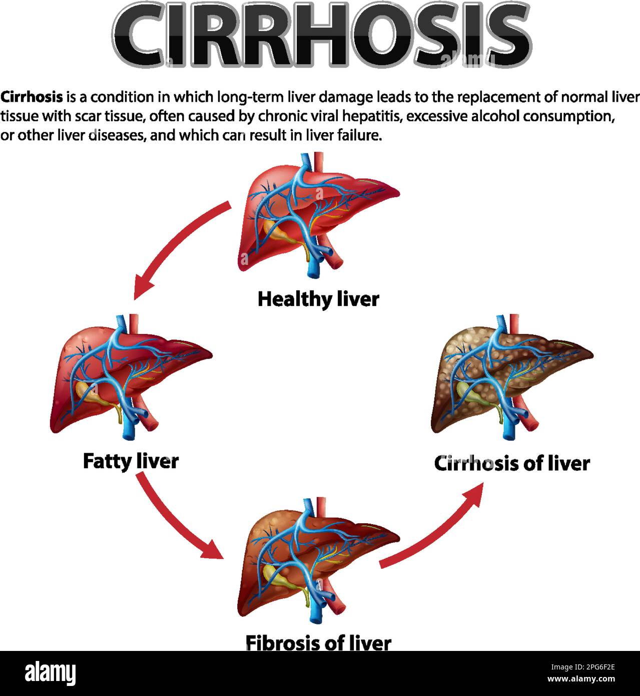 Maladie alcoolique du foie Banque d'images vectorielles - Page 2 - Alamy