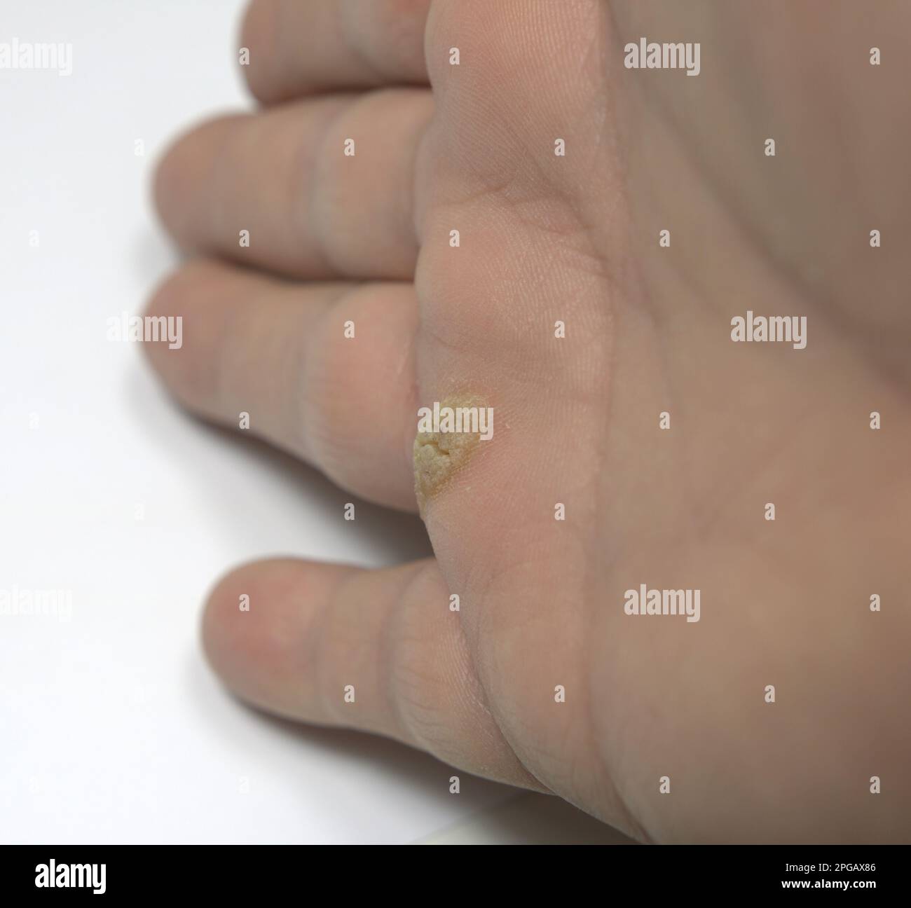 Verrues plantaire Banque de photographies et d’images à haute ...