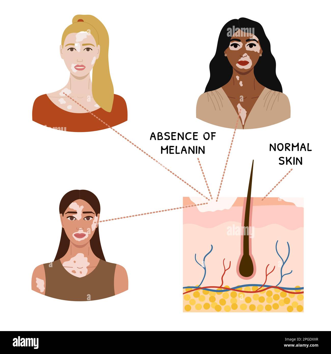 Infographie des visages féminins avec vitiligo. Affiche de la journée ...
