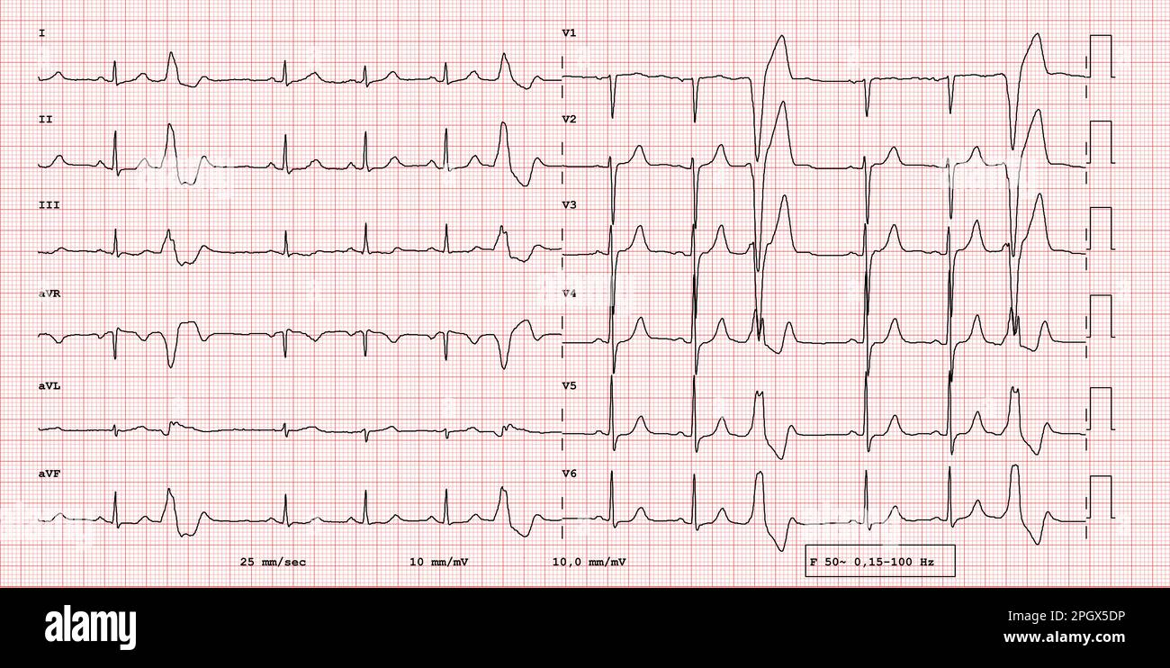 Exemple ECG de rythme 12 dérivations, extrasystole ventriculaire QRS ...