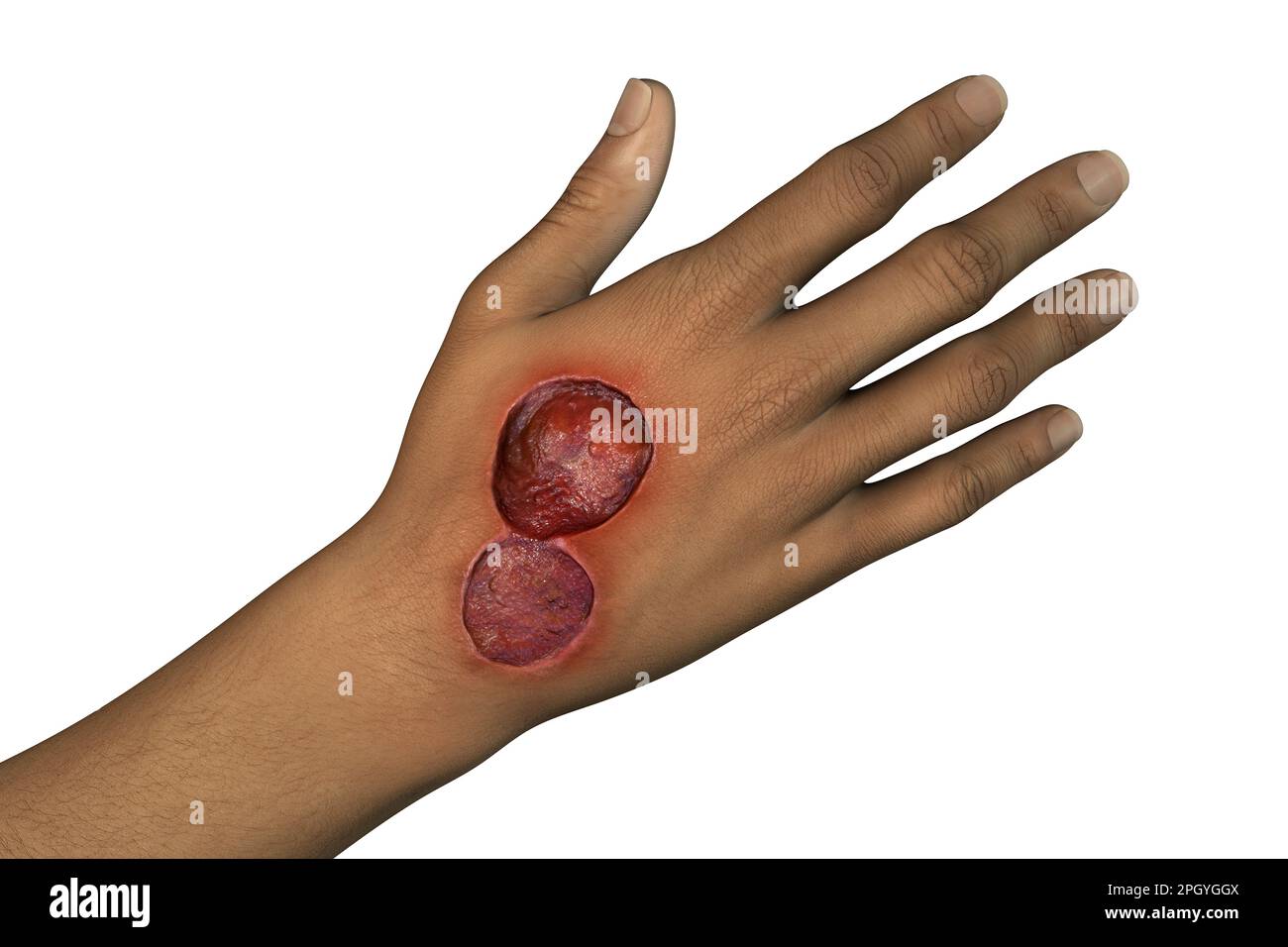Ulcère de buruli Banque de photographies et d’images à haute résolution ...