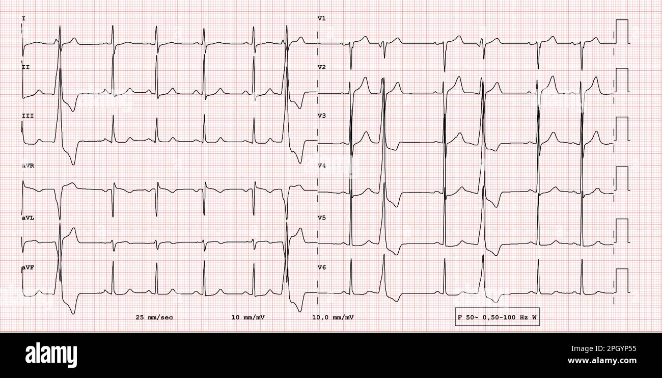 Exemple ECG de rythme 12 dérivations, examen de bigéminisme ...
