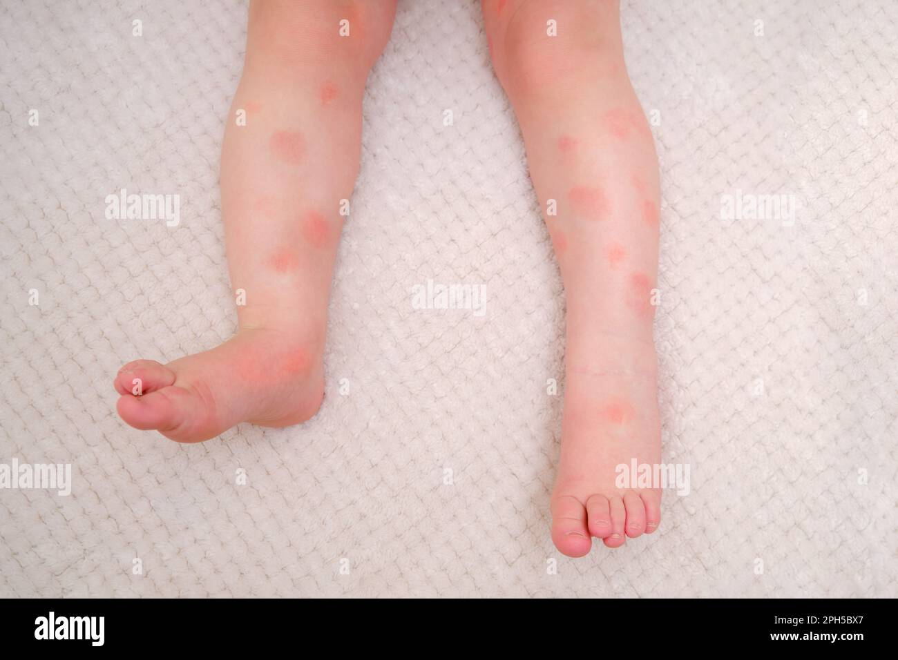 Dermatite atopique bébé Banque de photographies et d’images à haute ...