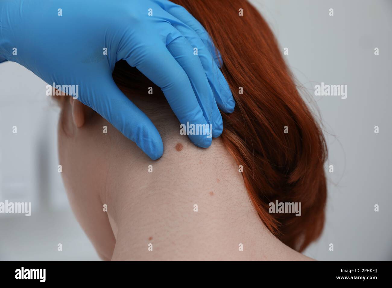 Naevus bleu Banque de photographies et d’images à haute résolution - Alamy
